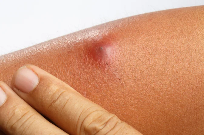 Expert Abscess Surgery in India | mediSuggest